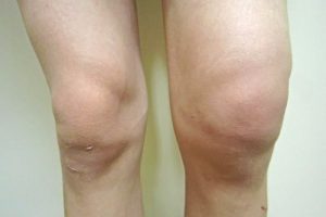 Knee Bursitis – Spine Sports Chiro
