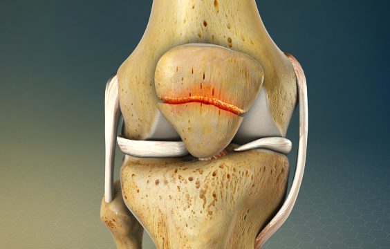 Patellar Fracture – Spine Sports Chiro