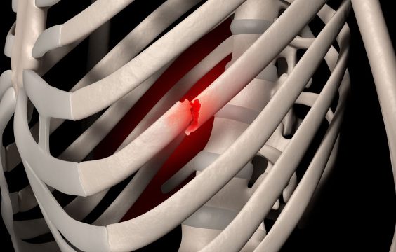 Rib Fracture – Spine Sports Chiro
