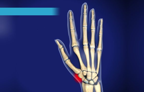 Scaphoid Fracture – Spine Sports Chiro